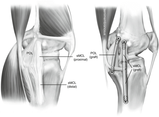 Treatment of MCL Injury in Combined ACL/MCL Injury | SpringerLink