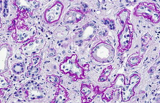 Nephronophthisis and Autosomal Dominant Interstitial Kidney Disease ...