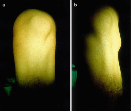 Treatment of Meniscus Degeneration and Meniscus Cysts | SpringerLink