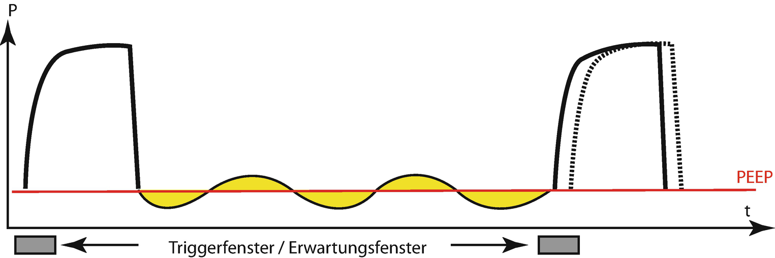 SIMV (Synchronized Intermittent Mechanical Ventilation) | SpringerLink