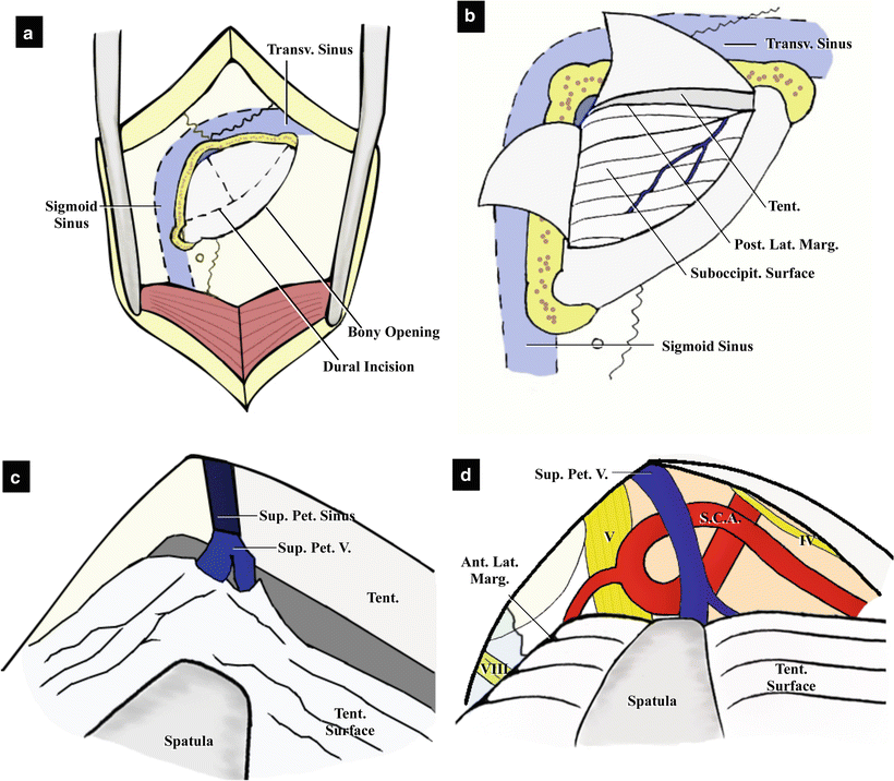 Microvascular Decompression Surgery for Trigeminal Neuralgia: Special ...