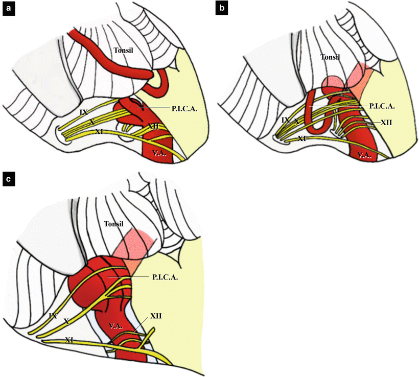Surgical Anatomy of and Approaches Through the Lateral Foramen Magnum ...