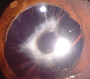 Histology of Posterior Capsular Opacification | SpringerLink