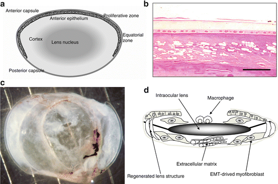 Histology of Posterior Capsular Opacification | SpringerLink