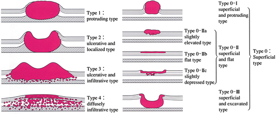 Stage Classifications: The UICC/AJCC Classifications and the Japanese ...