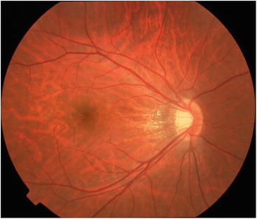 High Myopia and Myopic Glaucoma: Findings in the Peripapillary Retina ...