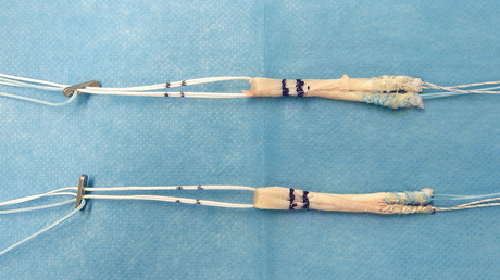 Single- Vs. Double-Bundle ACL Reconstruction | SpringerLink