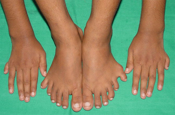 Duplication of Toes | SpringerLink