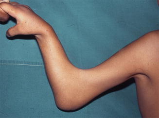 The Deformed Elbow | SpringerLink