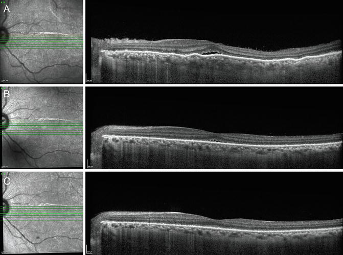 Posterior Scleritis | SpringerLink
