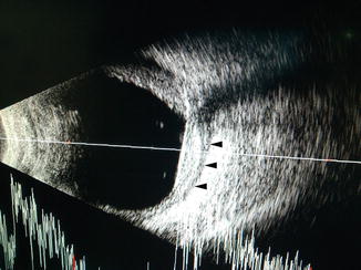 Posterior Scleritis | SpringerLink