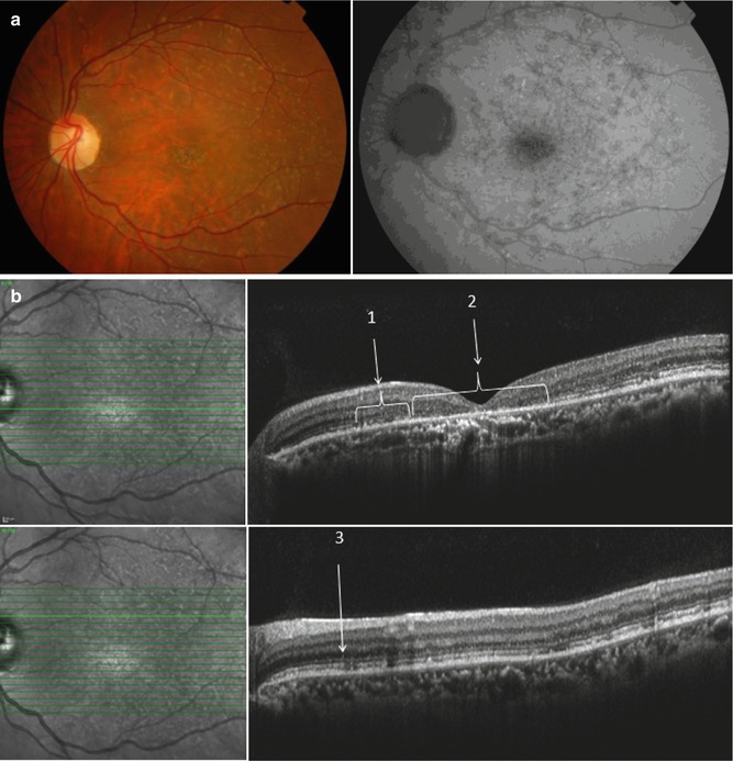 Retinal Dystrophies and Degenerations | SpringerLink
