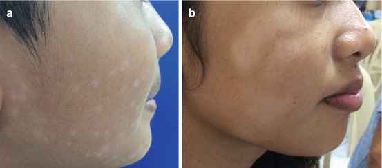 Differential Diagnosis of Vitiligo in Brown Skin | SpringerLink