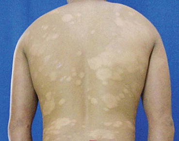 Differential Diagnosis of Vitiligo in Brown Skin | SpringerLink