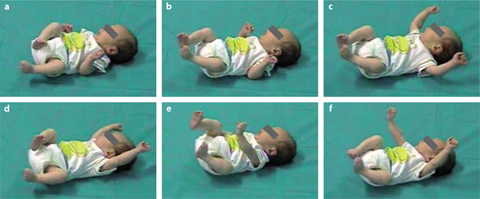 Neurological Examination of the Newborn Infant | SpringerLink