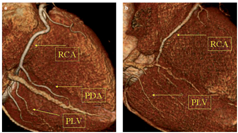 Clinical Anatomy of the Coronary Circulation | SpringerLink