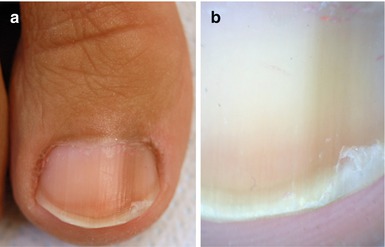 Tumors of the Nails | SpringerLink