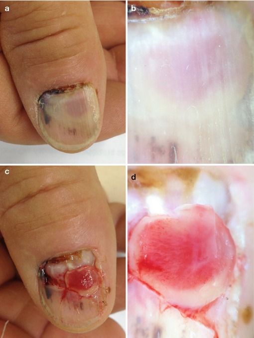 Tumors of the Nails | SpringerLink