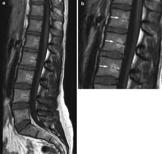 MRI of the Normal Bone Marrow: Anatomic Sites | SpringerLink