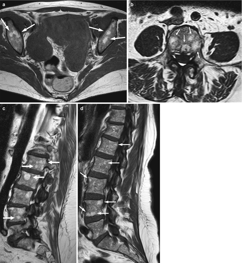 The Abnormal Bone Marrow: MRI Patterns | SpringerLink