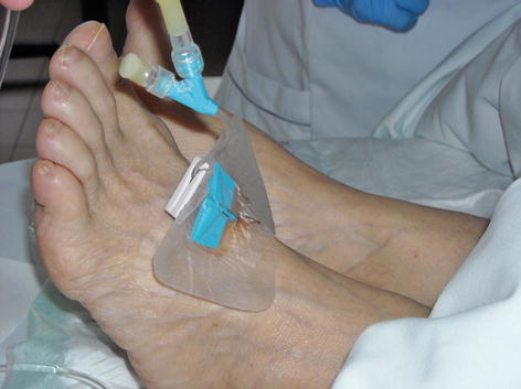 Advantages, Disadvantages, and Indications of PICCs in Inpatients and ...