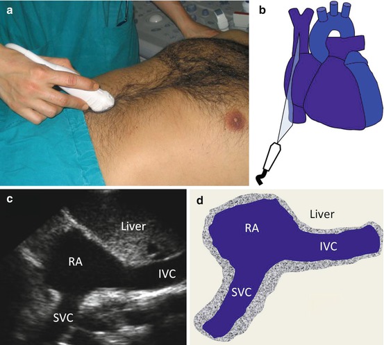 Evaluation Techniques of the PICC Tip Placement | SpringerLink