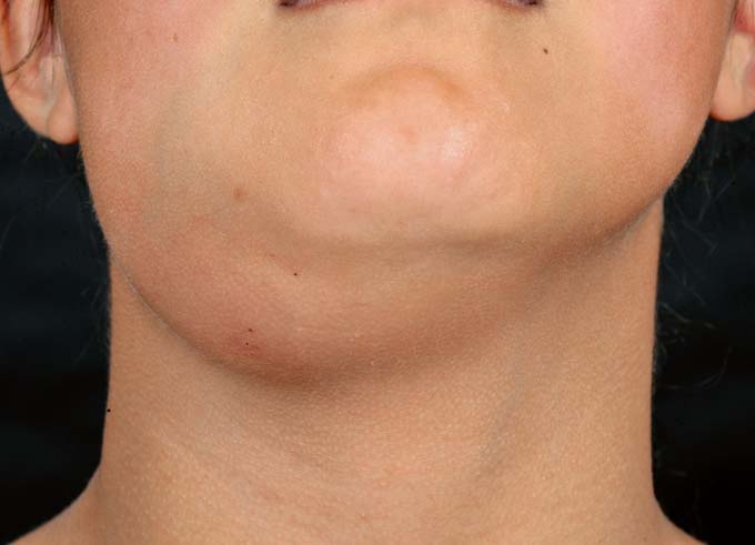 Afwijkingen van de hals | SpringerLink