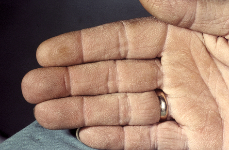 7 De huid en interne maligniteiten | SpringerLink