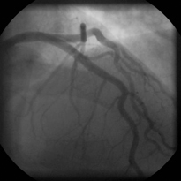 10 Segment 7 – het middensegment van de ramus descendens anterior ...