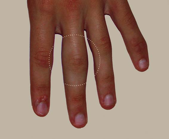 1 Een 14-jarige scholier met een pijnlijk gezwollen vinger nadat deze ...