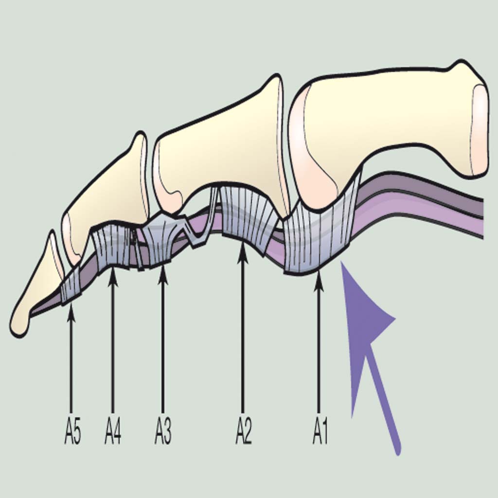 3a Addendum: trigger finger | SpringerLink