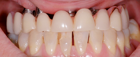 Behandeling van de edentate bovenkaak: brug of overkappingsprothese ...