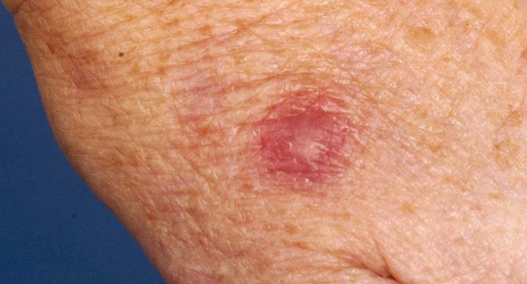 13 Nod(ul)euze dermatosen | SpringerLink