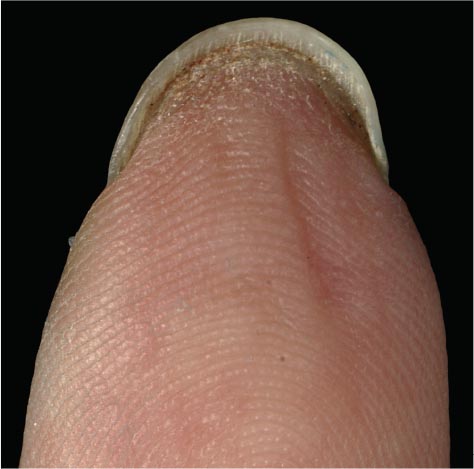 Afwijkingen van de nagelwallen, het nagelbed, de cuticula en het ...