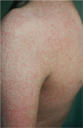 Rodehond/rubella | SpringerLink