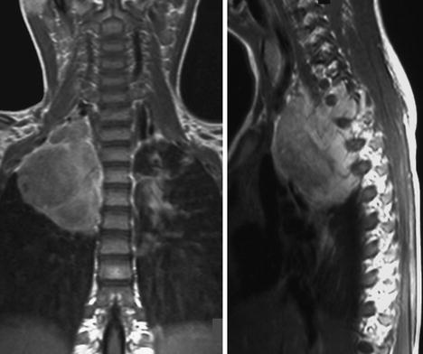 Pediatric Neuroblastoma-Associated Opsoclonus-Myoclonus-Ataxia Syndrome ...