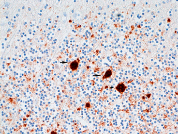Human Prion Diseases: From Kuru to Variant Creutzfeldt-Jakob Disease ...
