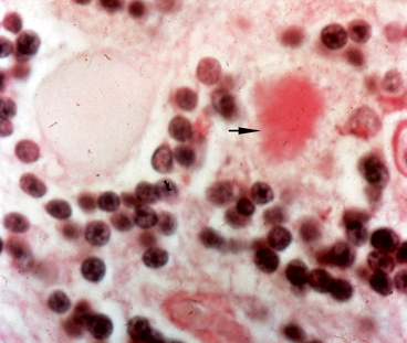Human Prion Diseases: From Kuru to Variant Creutzfeldt-Jakob Disease ...