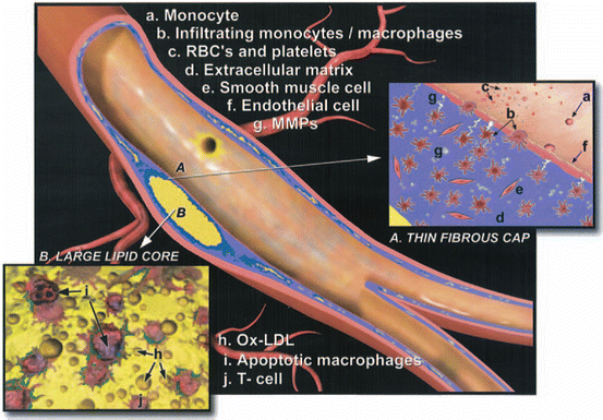 Biomarkers of Coronary Plaque Composition and Vulnerability | SpringerLink