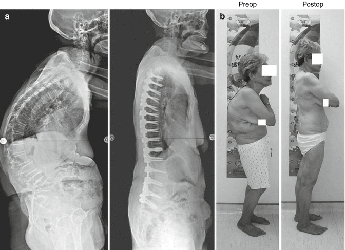 Smith-Peterson Osteotomy and Ponte Osteotomy | SpringerLink