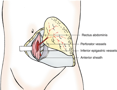 Deep Inferior Epigastric Artery Perforator (DIEP) Flap | SpringerLink
