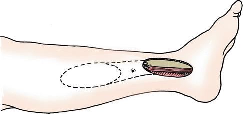 Posterior Tibial Artery Perforator Flap | SpringerLink