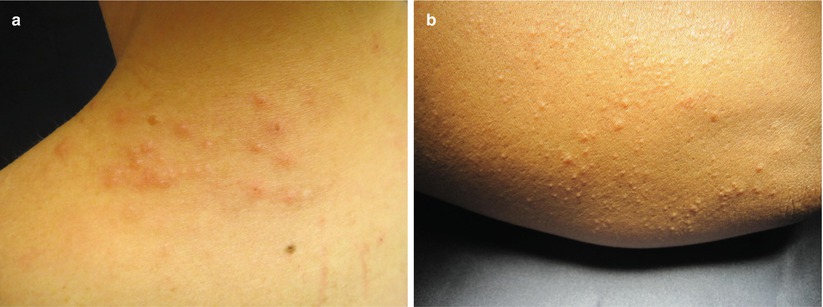Skin Diseases Caused by Factors from the Environment | SpringerLink