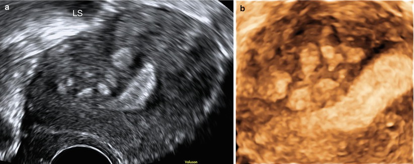 Ultrasound Evaluation of Myometrium | SpringerLink
