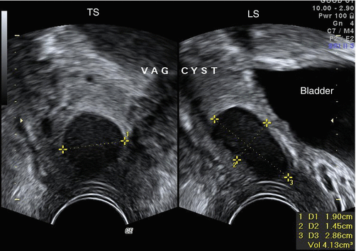 Ultrasound Evaluation of the Vagina | SpringerLink