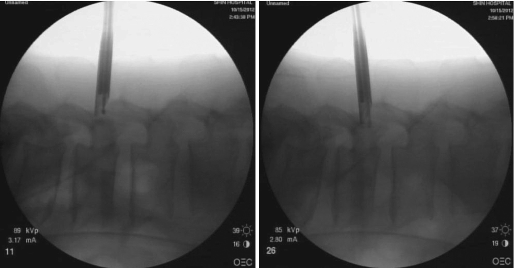 Percutaneous Full-Endoscopic Interlaminar Lumbar Spine Surgery ...