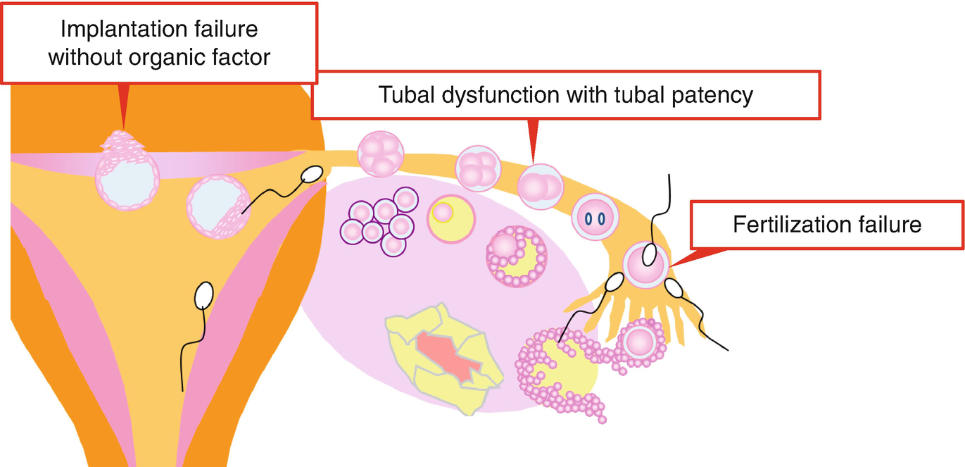 Unexplained Infertility: Treatment Strategy for Unexplained Infertility ...