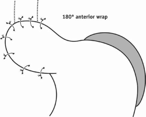 Gastro-esophageal Reflux | SpringerLink
