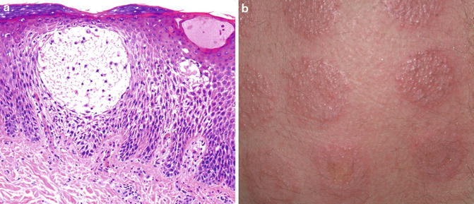 Spongiosis | SpringerLink