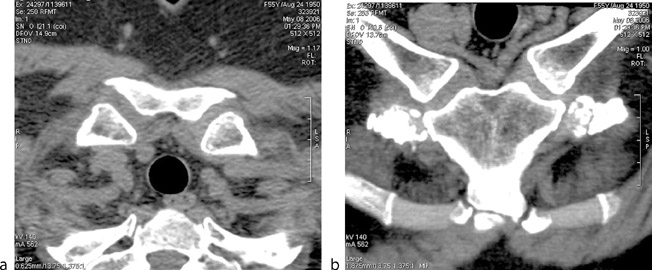 Tietze's Syndrome | SpringerLink